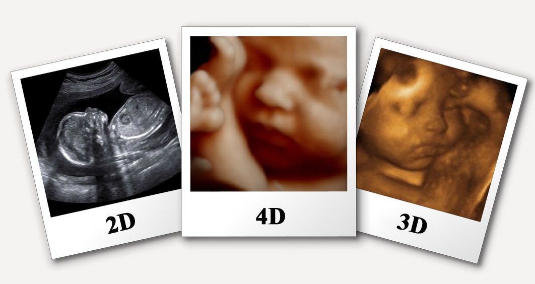 3d/4d Ultrasound Scan – 4d Diagnostics